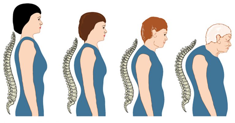 Upper Back Hump - Shakti Chiropractic